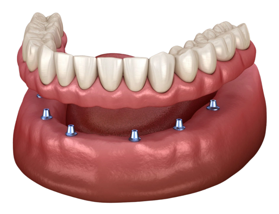 Snap-In Implant Dentures at Phoenix AZ | Dental Home Family Dentistry